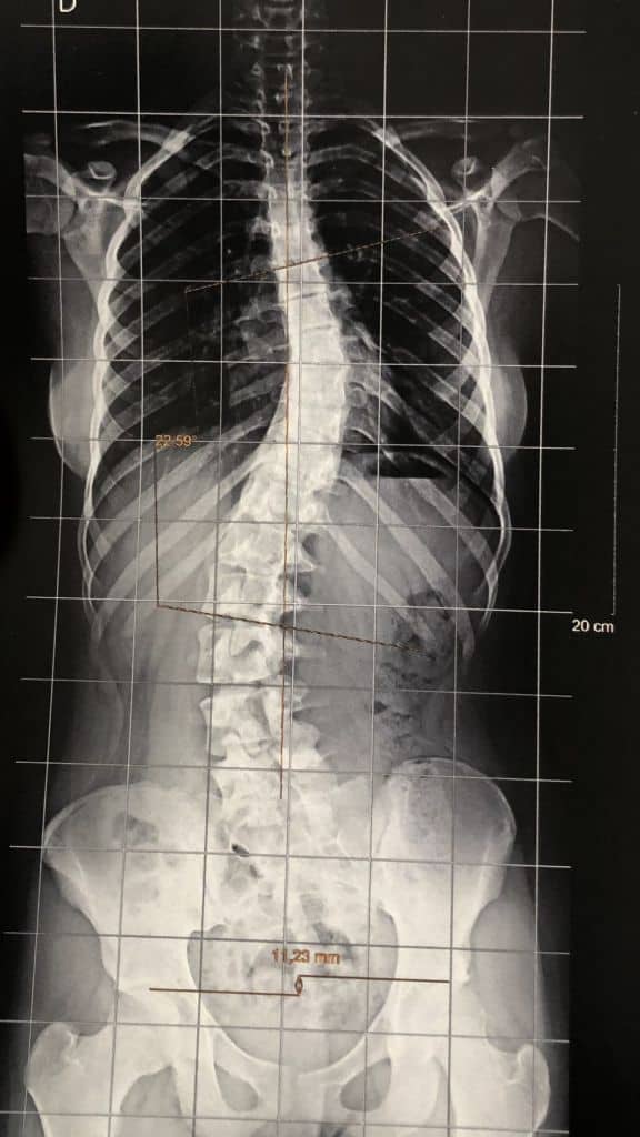 Escoliose - Dr Antônio Prates, Neurocirurgião em BH Escoliose - Dr Antônio Prates, Neurocirurgião em BH